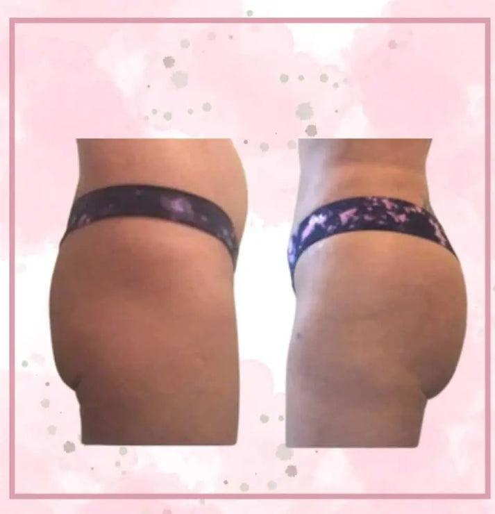 Brazilian Buttock Lift Sacramento